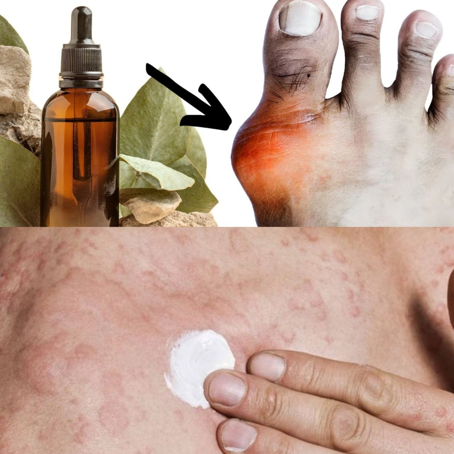 Amazing Oil Cures Gout - EASY RECIPES